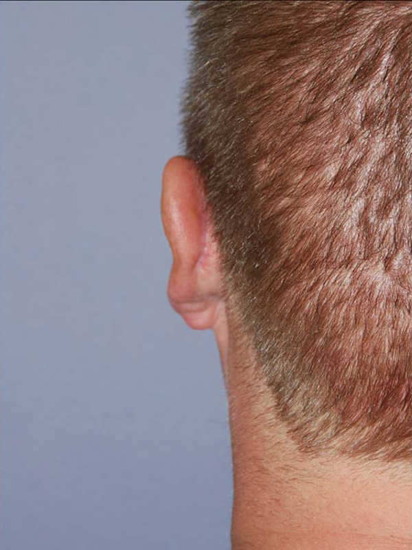 Ear Correction Surgery Pekin, Otoplasty Peoria IL