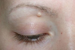 Scarless Skin Lesion Removal Pekin, Mole Removal Peoria IL